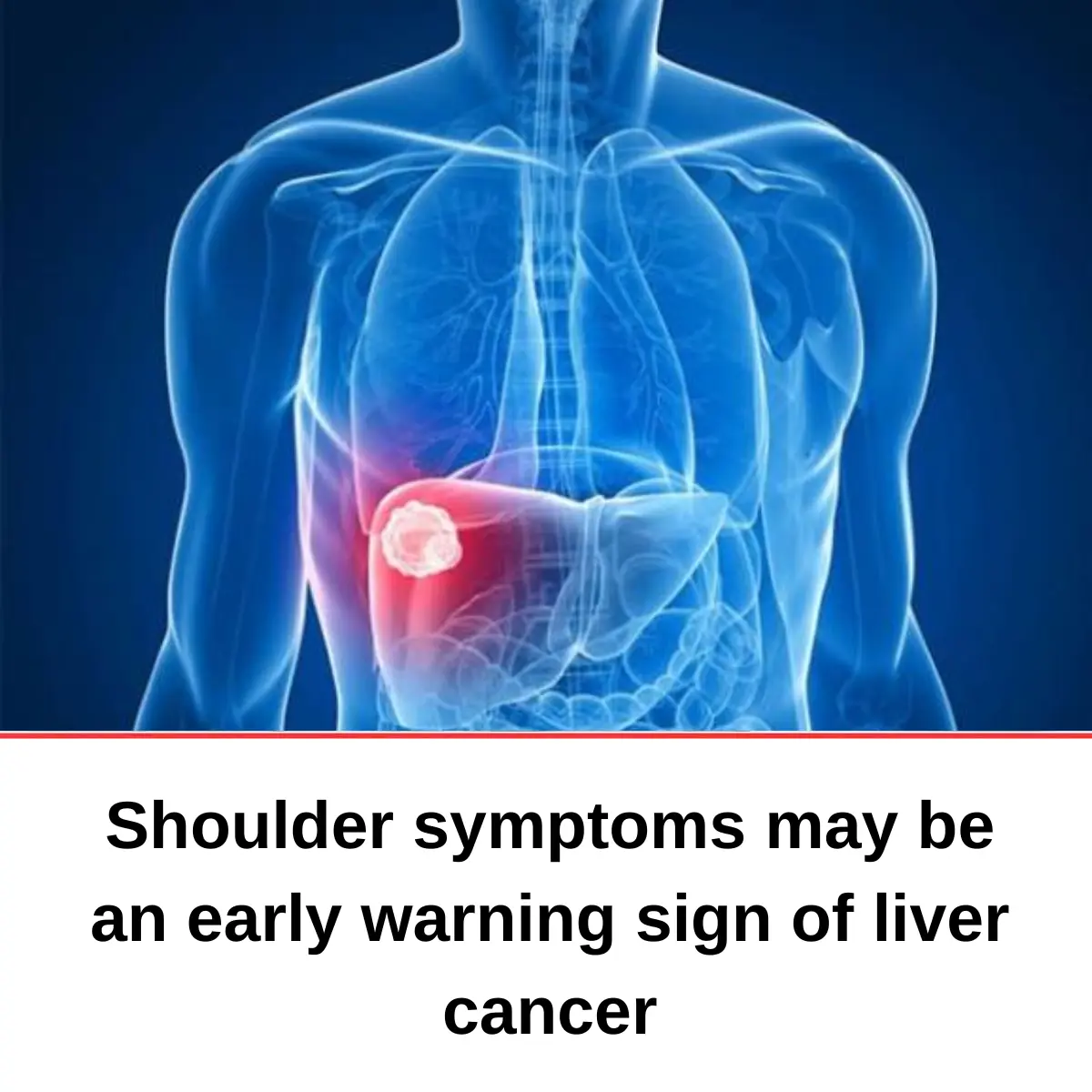 Shoulder Symptoms May Be an Early Warning Sign of Liver Cancer