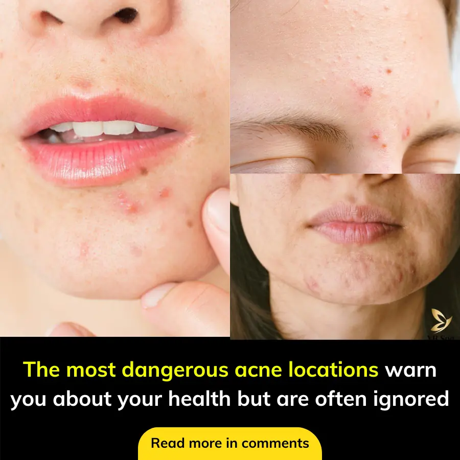 The most dangerous acne locations warn you about your health but are ...