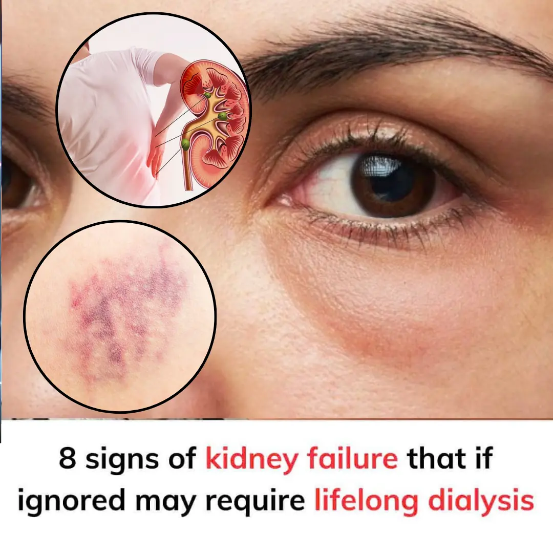 8 signs of kidney failure that if ignored may require lifelong dialysis