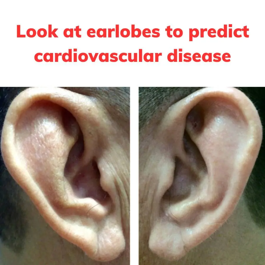 Look at earlobes to predict cardiovascular disease