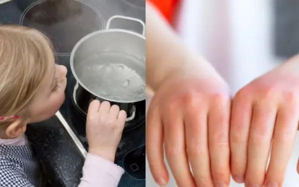 How to tr.e.at steam burns at home