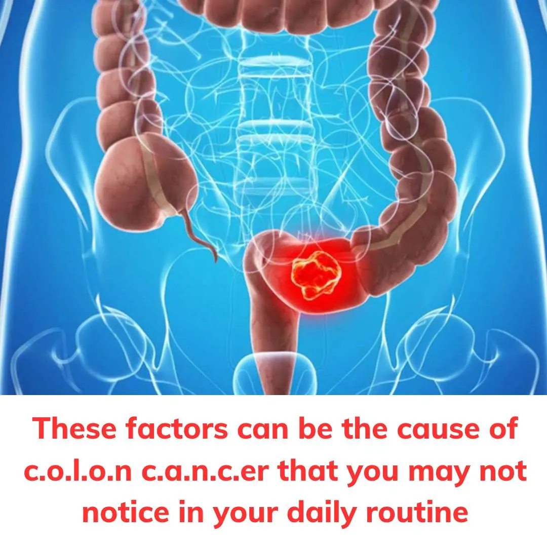 These factors can be the cause of c.o.l.on c.a.n.c.er