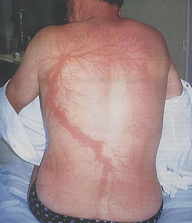 This man was struck by lightning 7 times but did not d.i.e