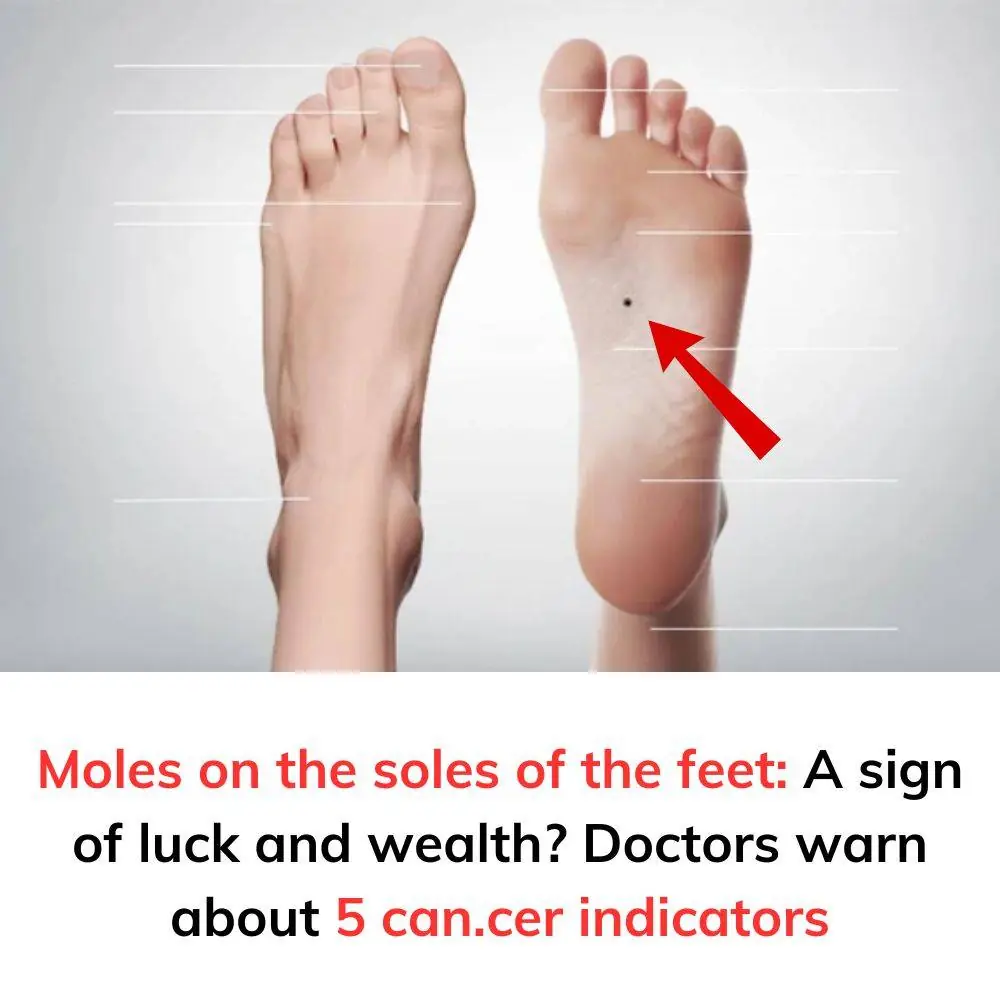 Moles on the Soles of the Feet: A Sign of Luck and Wealth?