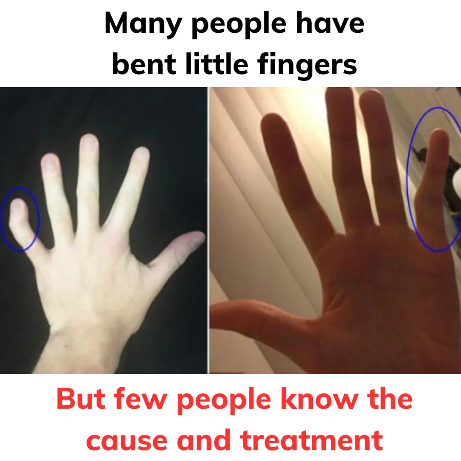 Many people have bent little fingers