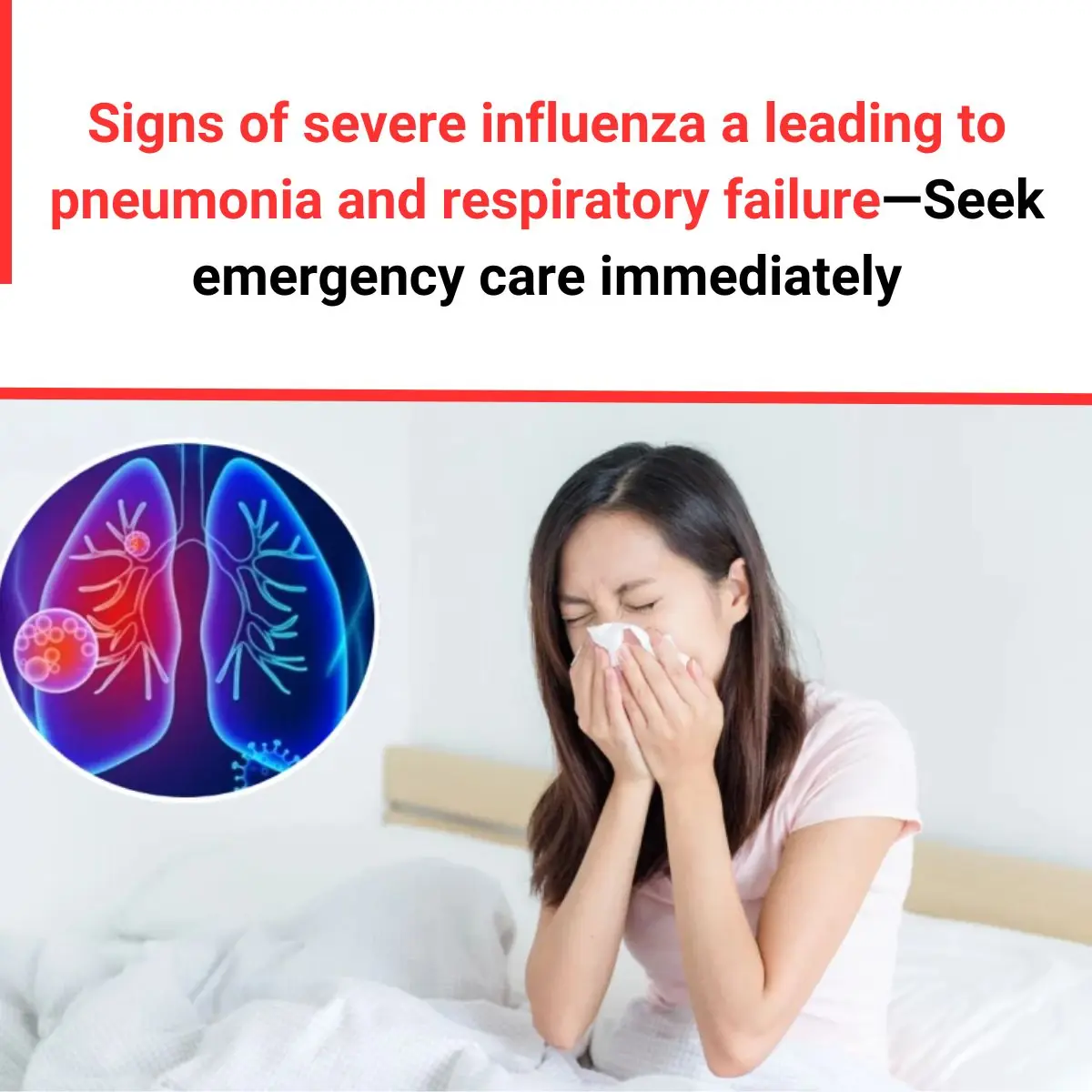 Signs of Severe Influenza A Leading to Pneumonia and Respiratory Failure