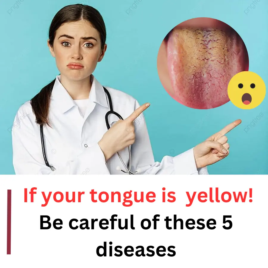 If your tongue is yellow, be careful of these 5 diseases