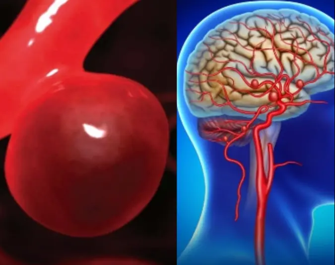 7 signs of a rup.tured brain ane.urysm