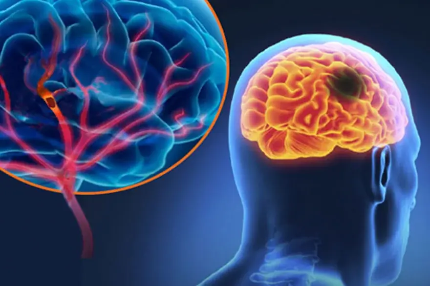 4 Common Morning Mistakes That Could Put You at Higher Risk of Stroke