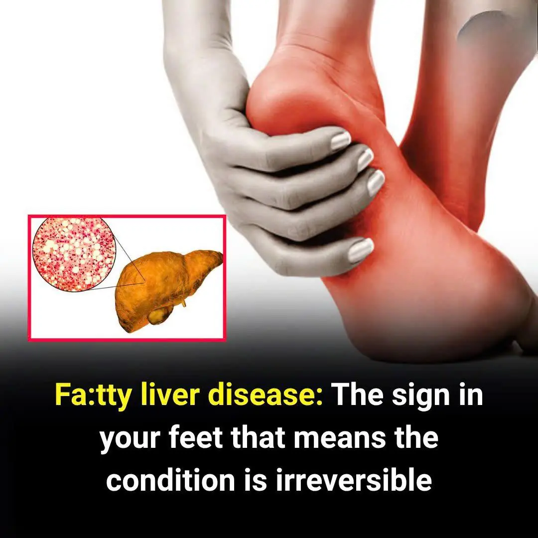 A change in your feet may signal severe fatty liver disease — don’t ...